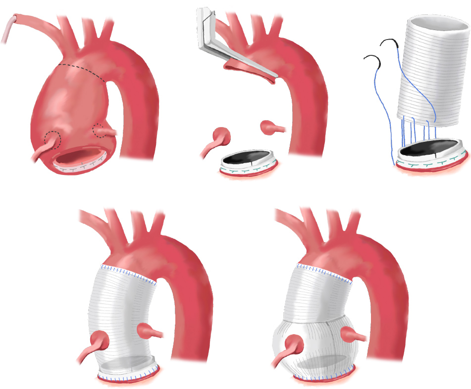 東京で大動脈瘤手術ならニューハート・ワタナベ国際病院